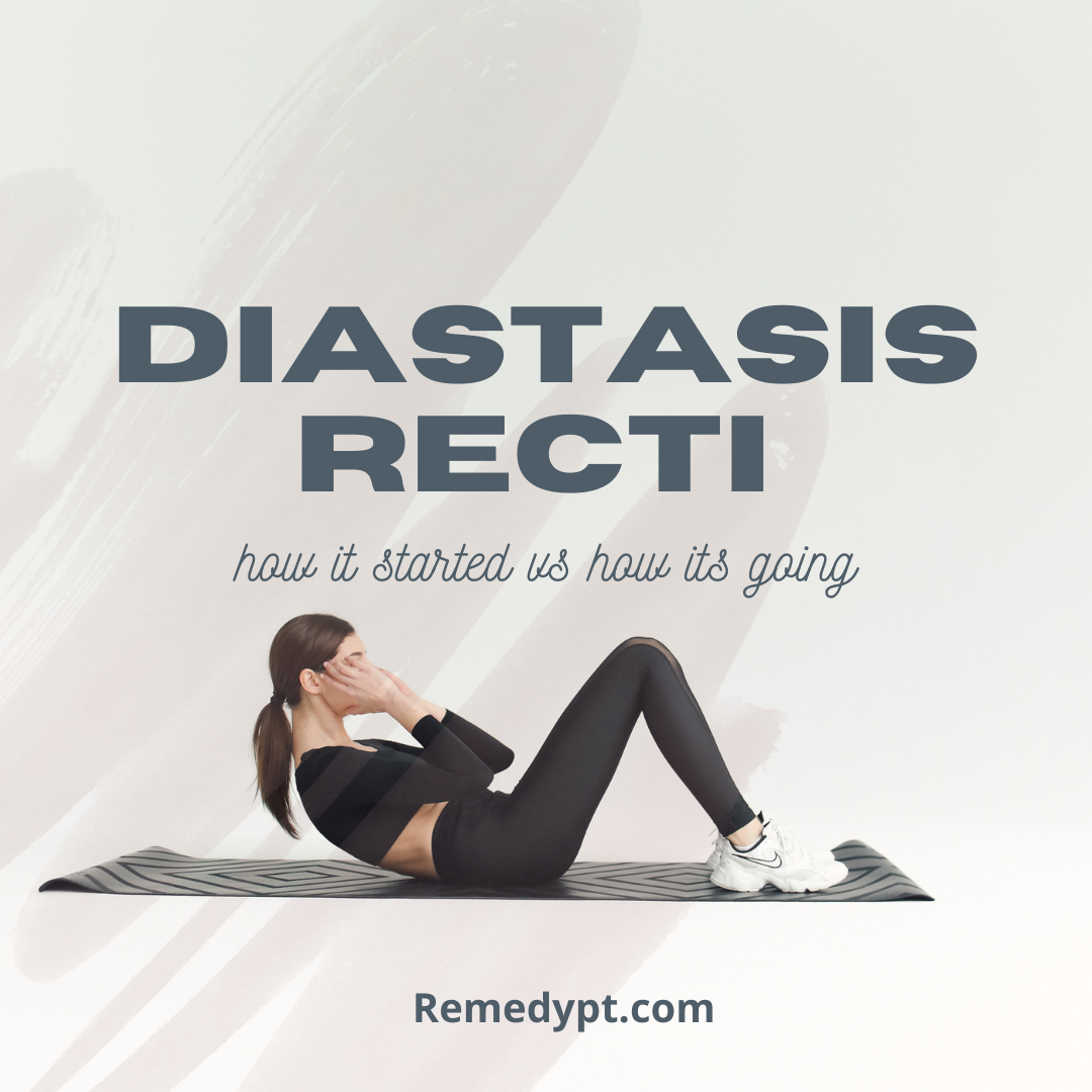 Diastasis Recti - How it started vs How it's going - Remedy Physical ...